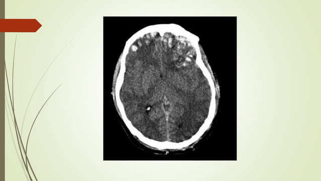 CEREBRAL CONTUSION Presentation Slide share | PPTX | Death, Injury, or ...