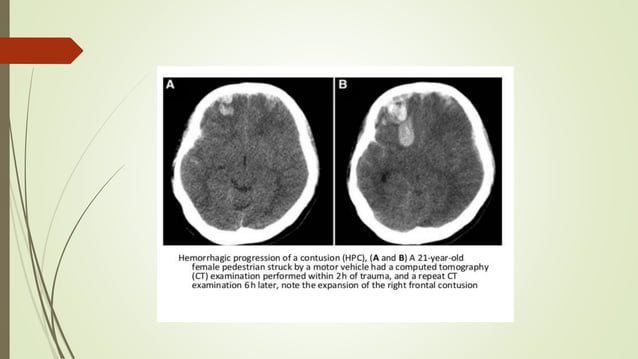 CEREBRAL CONTUSION Presentation Slide share | PPTX | Death, Injury, or ...