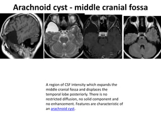 arachnoid cyst | PPTX