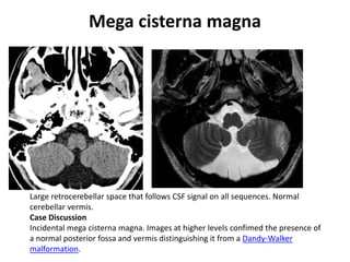 arachnoid cyst | PPTX