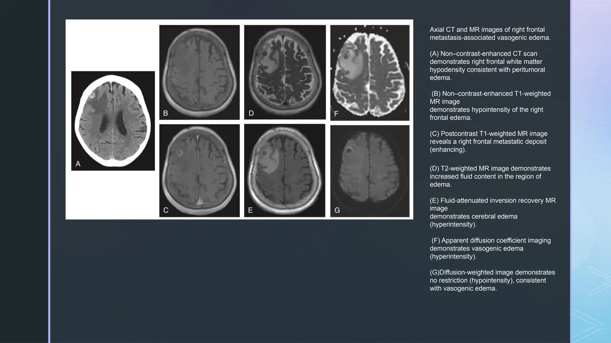 CEREBRAL EDEMA types mechanism with imaging | PPTX