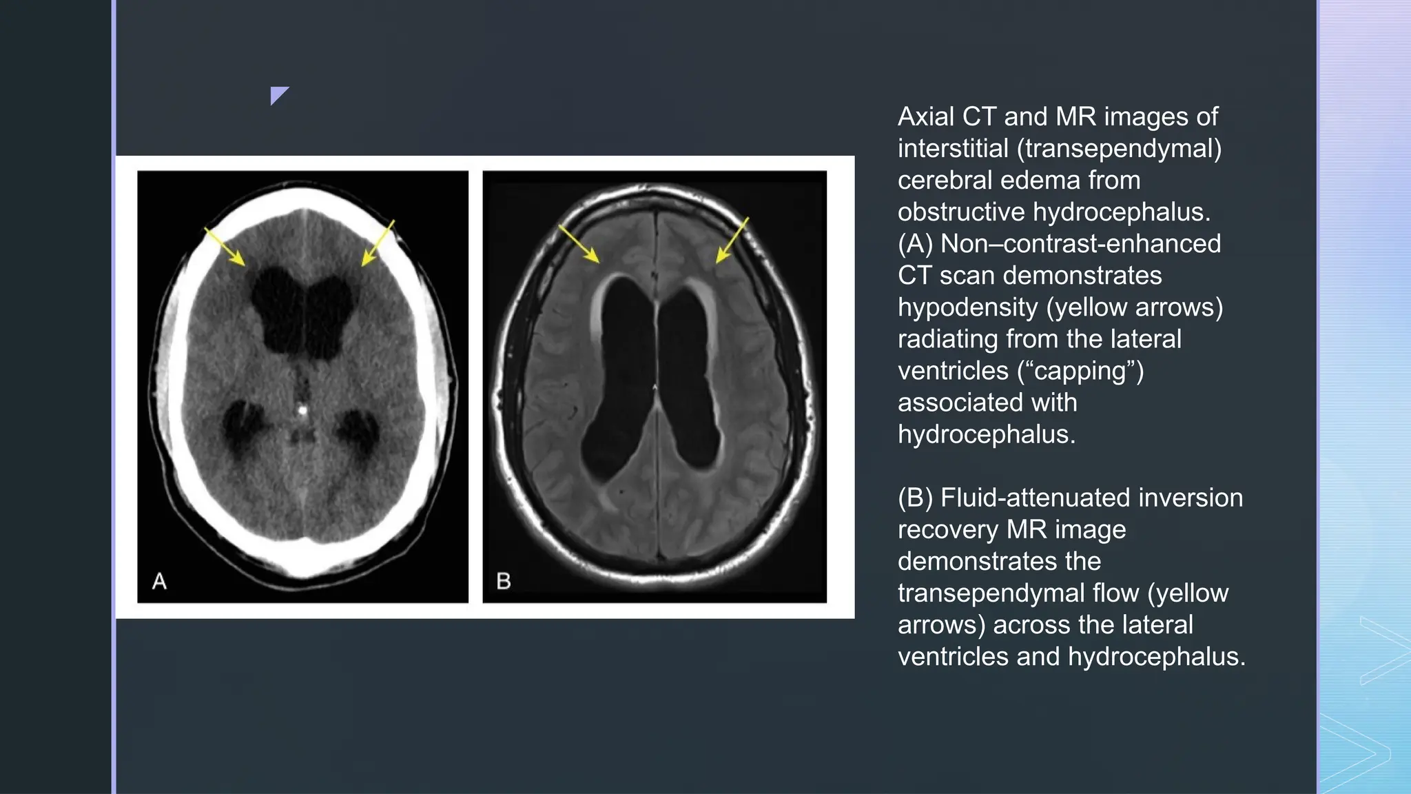CEREBRAL EDEMA types mechanism with imaging | PPTX