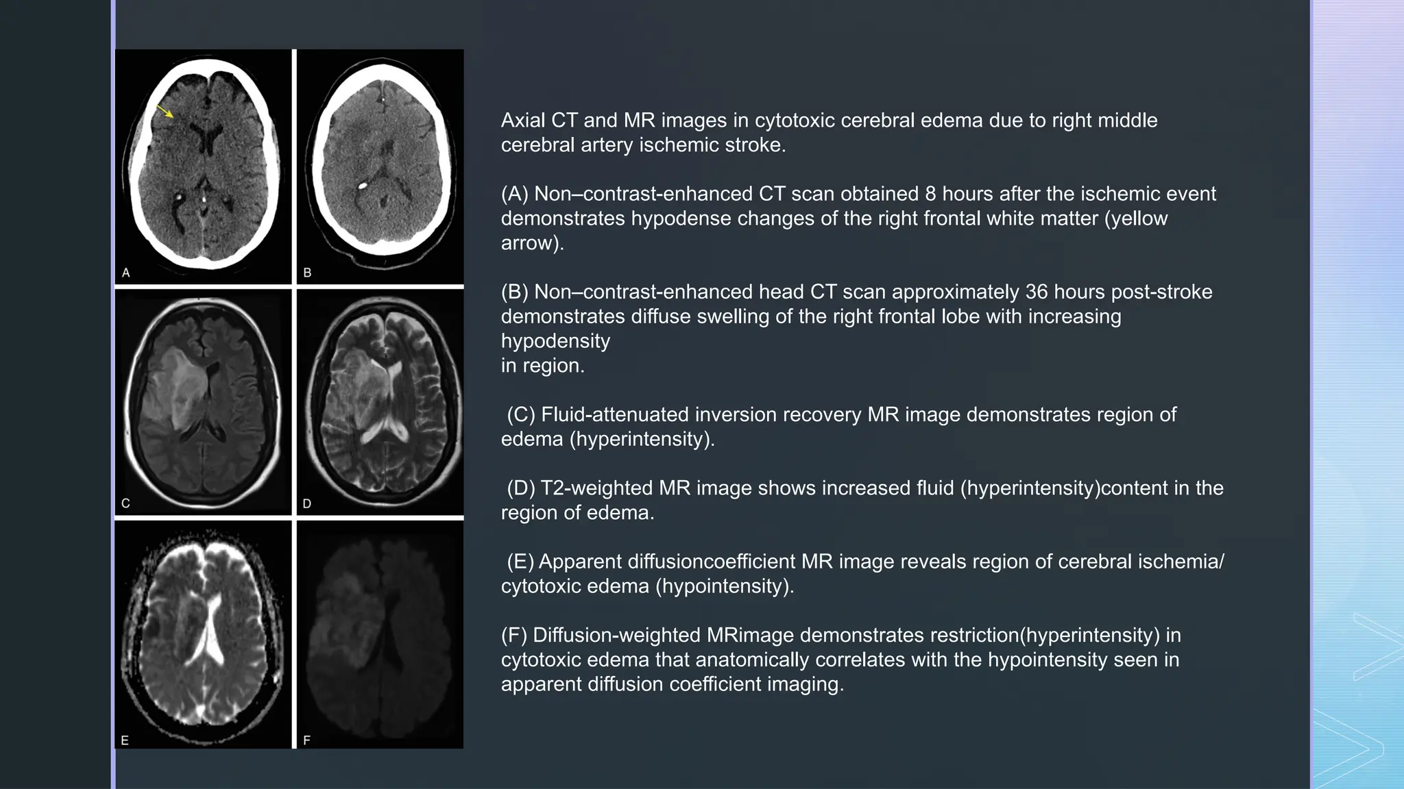 CEREBRAL EDEMA types mechanism with imaging | PPTX