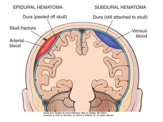 Cerebral Hemorrhage and Traumatic Brain Injury | PPT