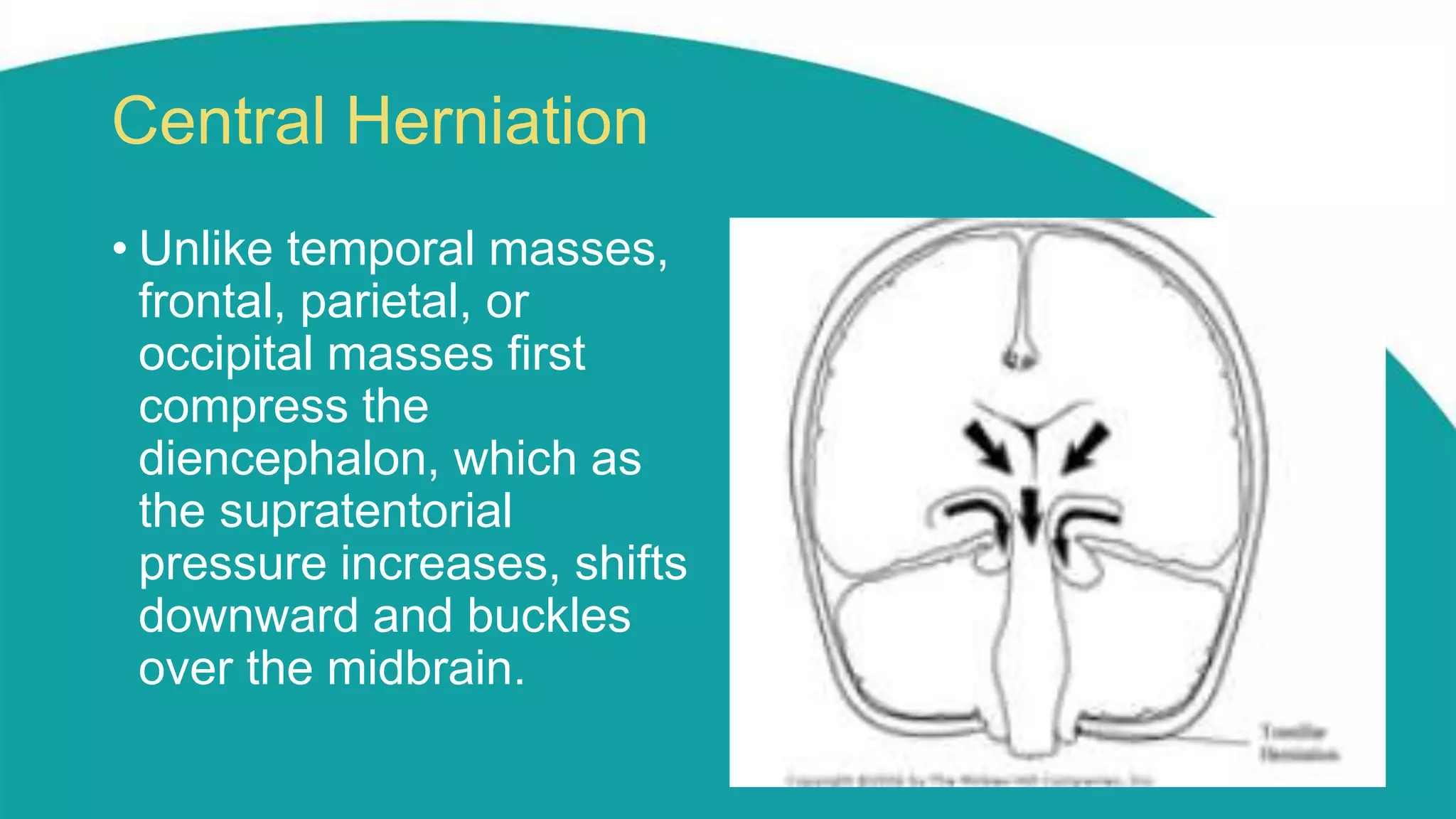 Cerebral herniation syndromes | PPTX