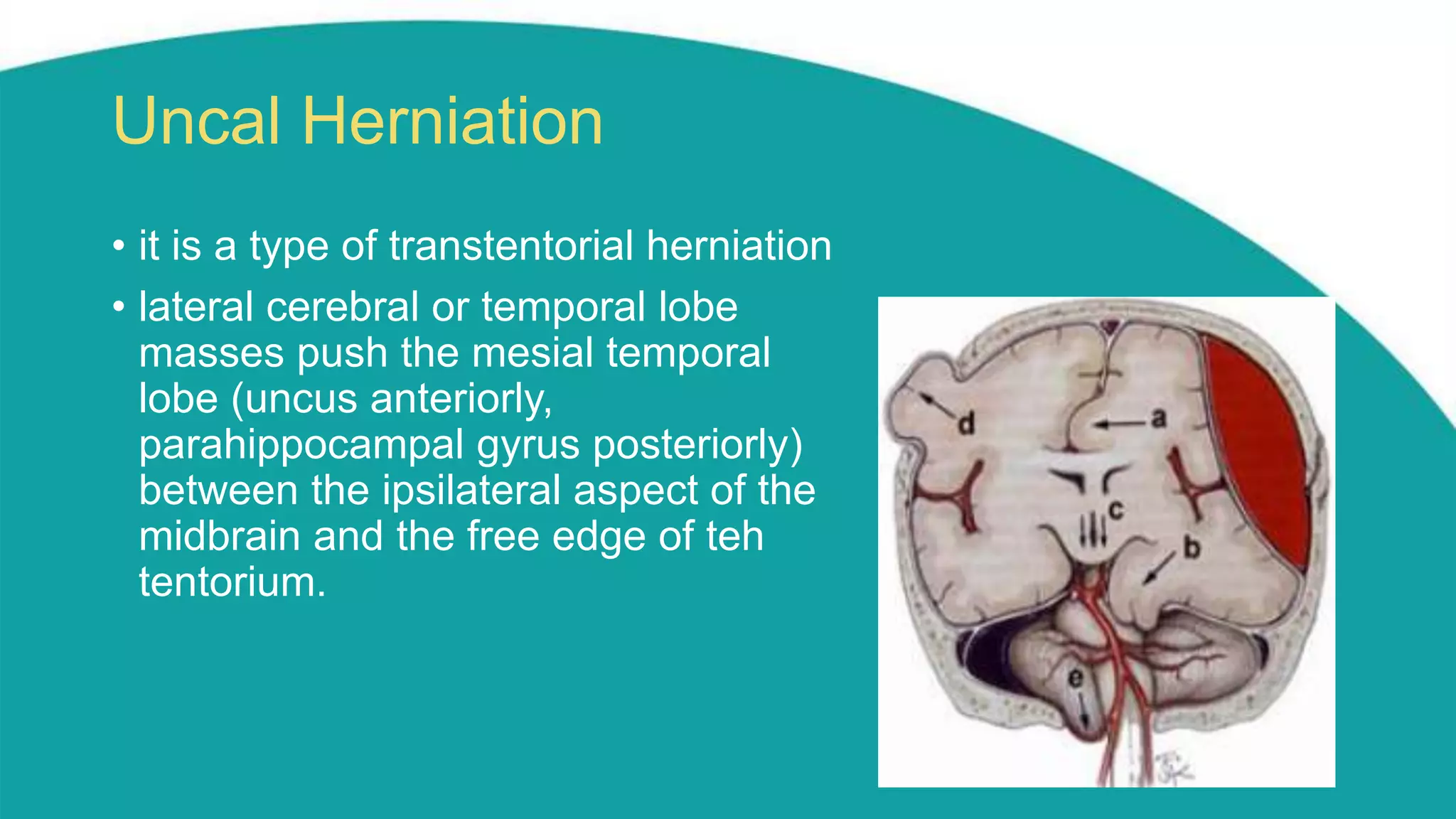 Cerebral herniation syndromes | PPTX