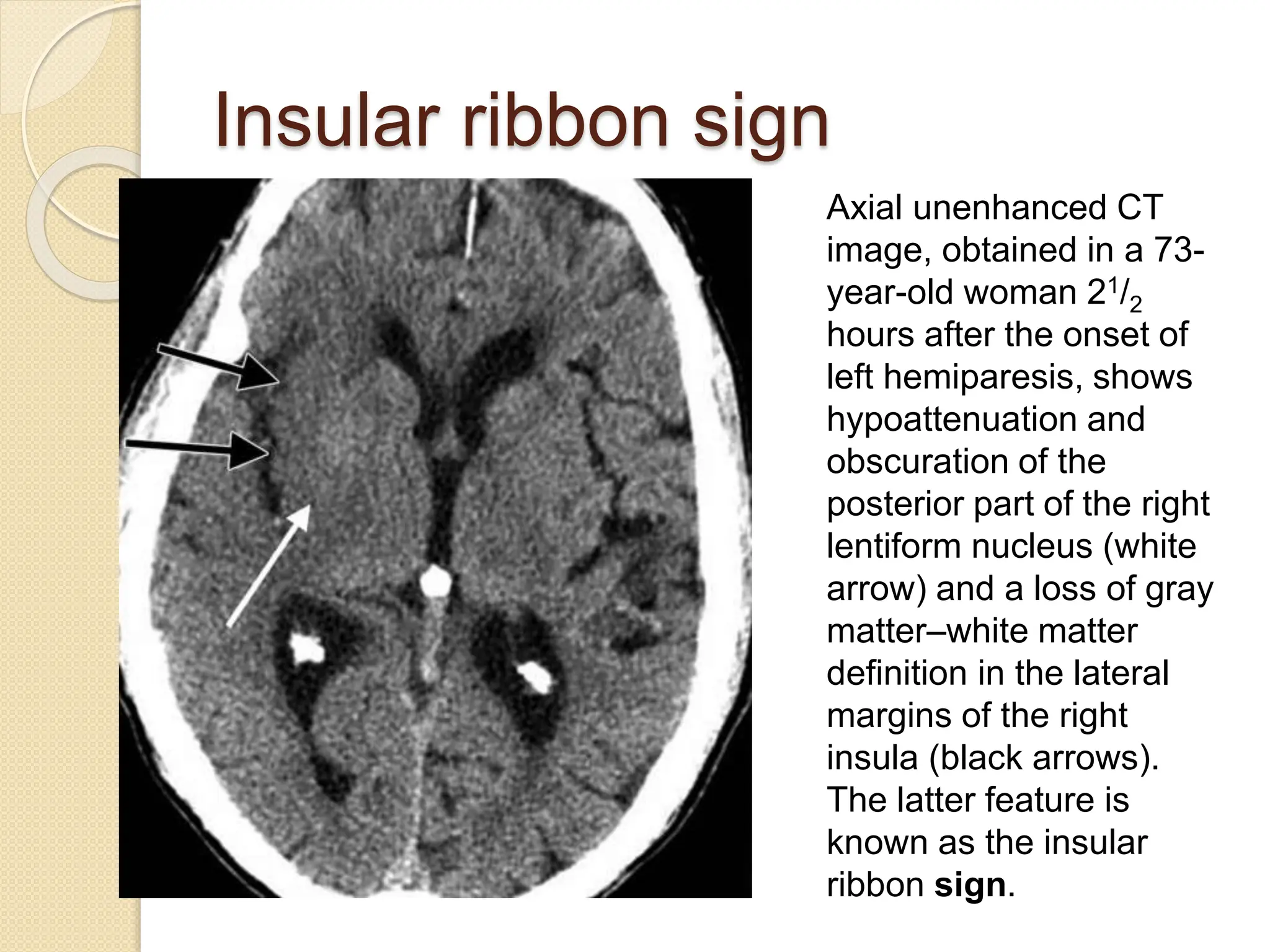 Cerebral Infarcts . pptx | PPTX