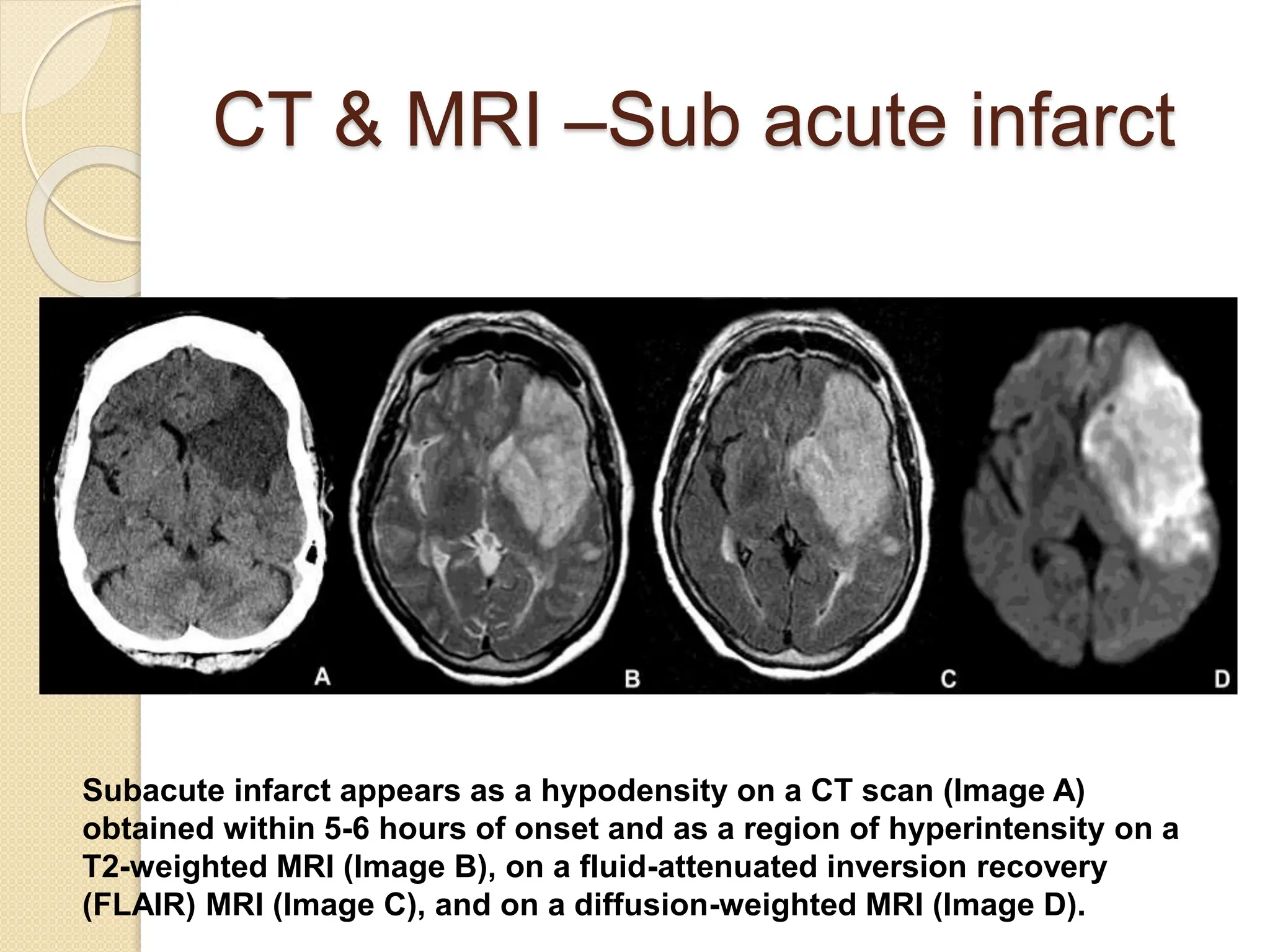 Cerebral Infarcts . pptx | PPTX