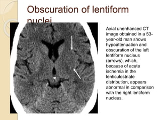 Cerebral Infarcts . pptx | PPTX