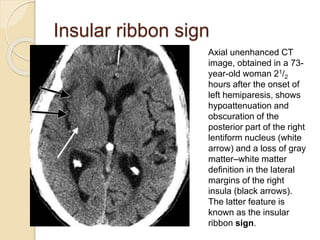 Cerebral Infarcts . pptx | PPTX
