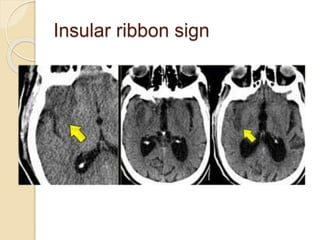 Cerebral Infarcts . pptx | PPTX