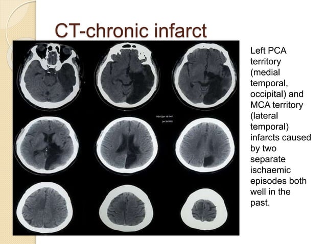 Cerebral Infarcts . pptx | PPTX