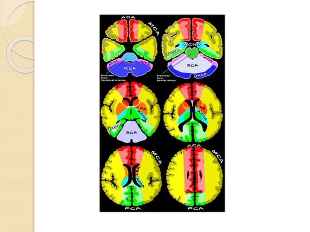 Cerebral Infarcts . pptx | PPTX