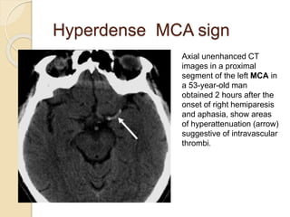 Cerebral Infarcts . pptx | PPTX