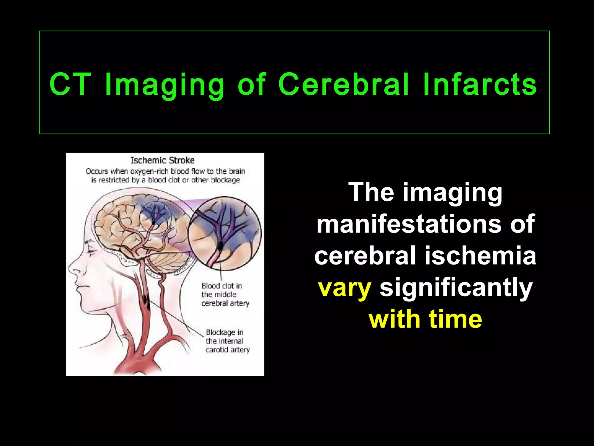 CT Imaging of Cerebral Ischemia and Infarction | PPT
