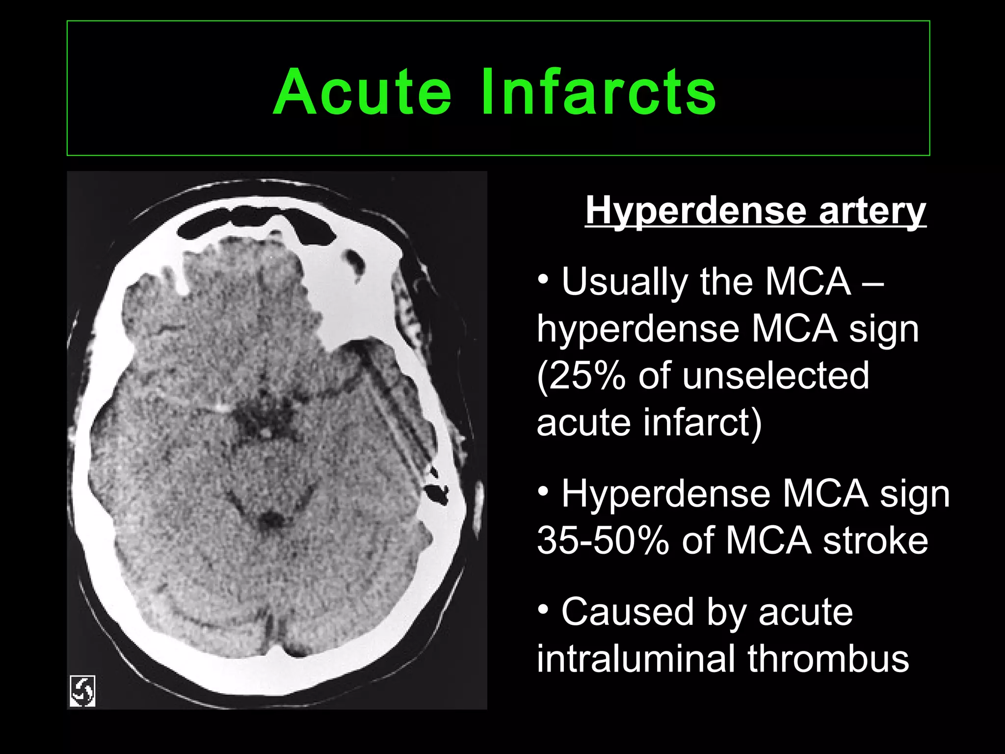 CT Imaging of Cerebral Ischemia and Infarction | PPT