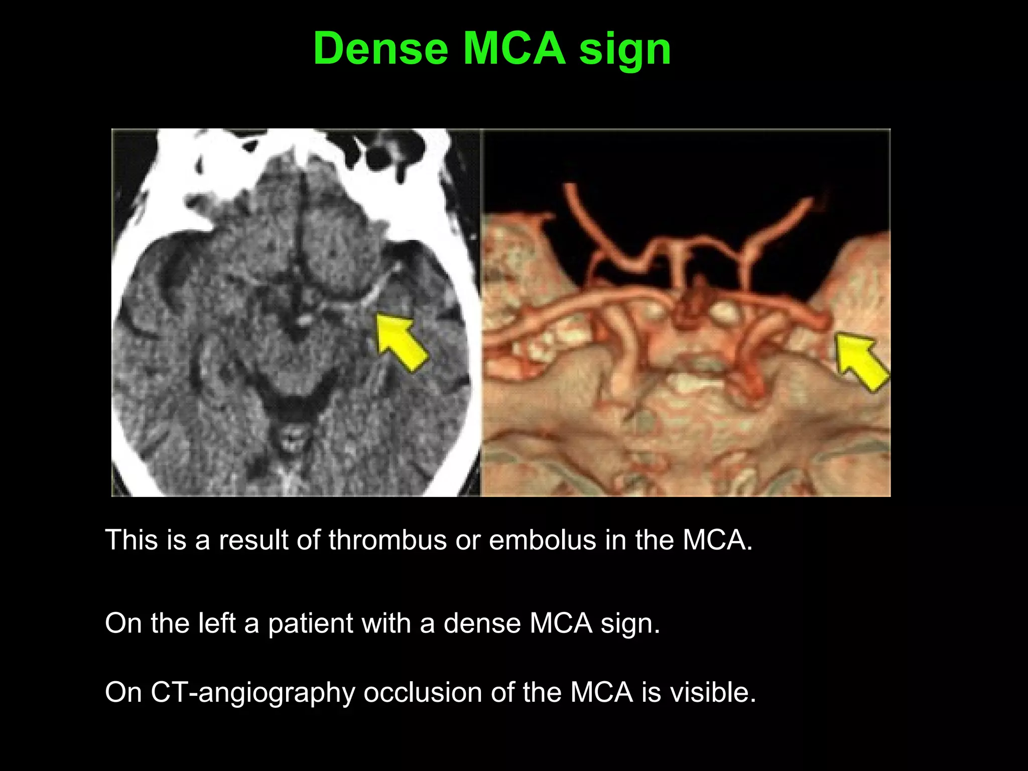 CT Imaging of Cerebral Ischemia and Infarction | PPT