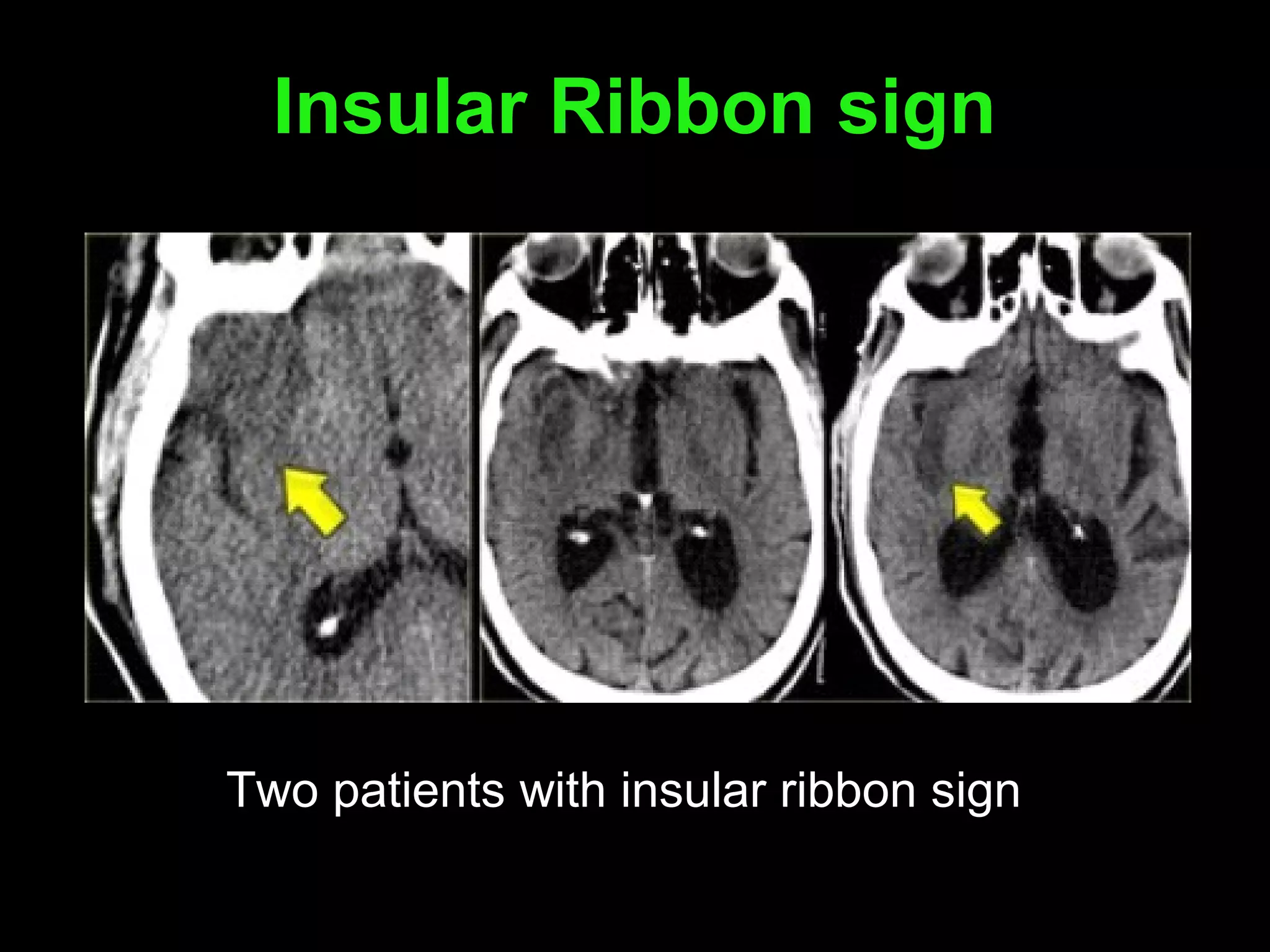 CT Imaging of Cerebral Ischemia and Infarction | PPT