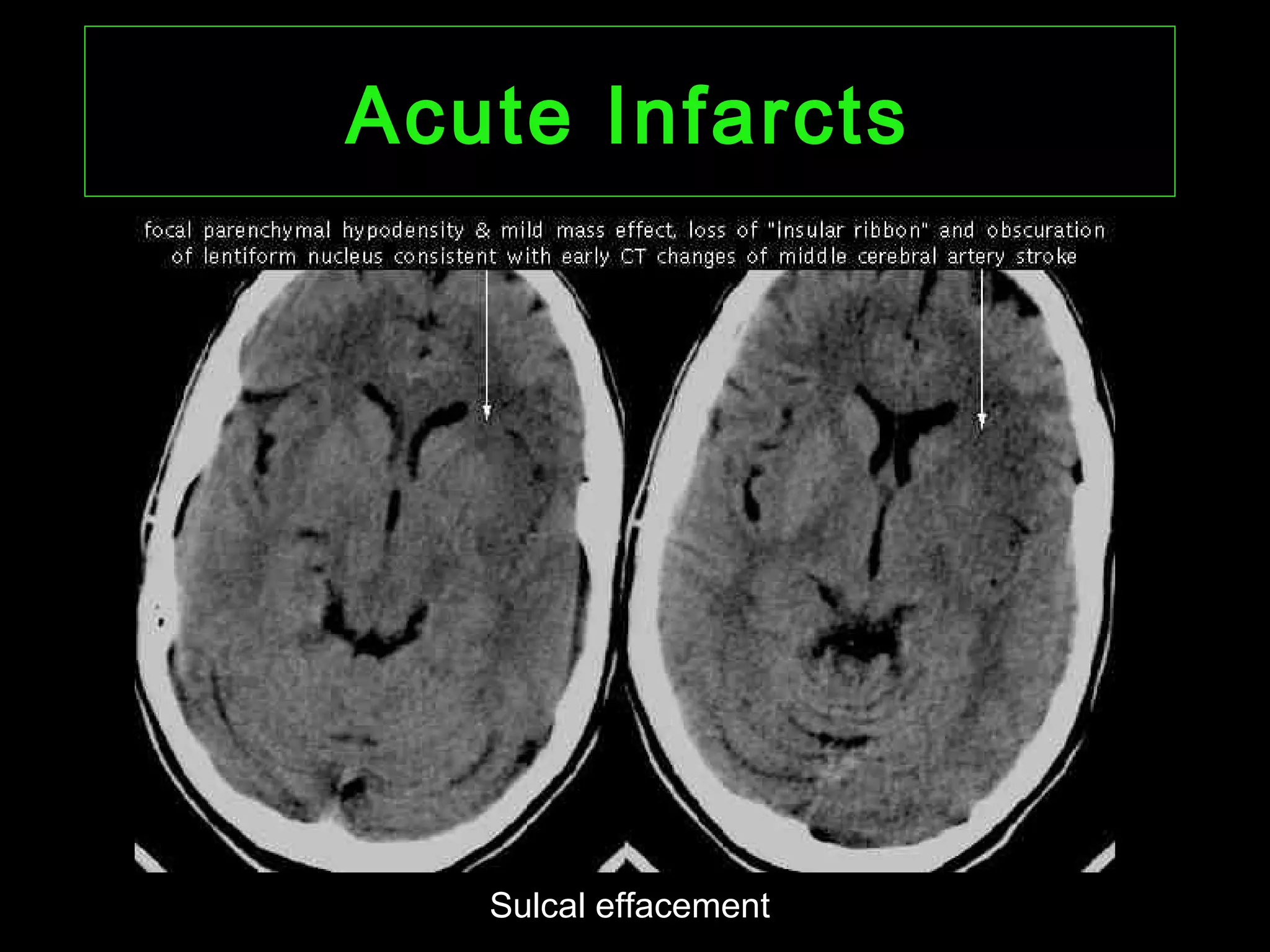 CT Imaging of Cerebral Ischemia and Infarction | PPT