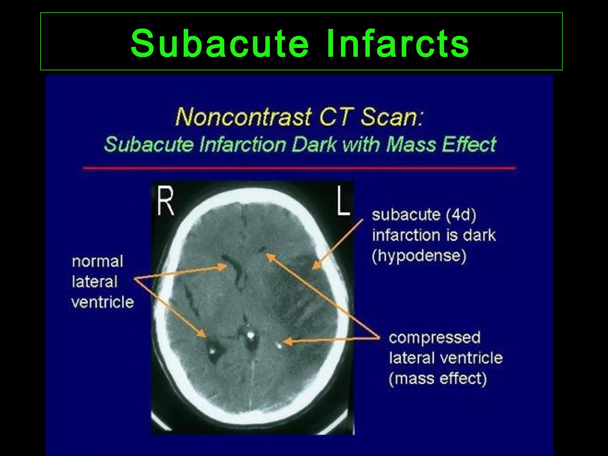 CT Imaging of Cerebral Ischemia and Infarction | PPT