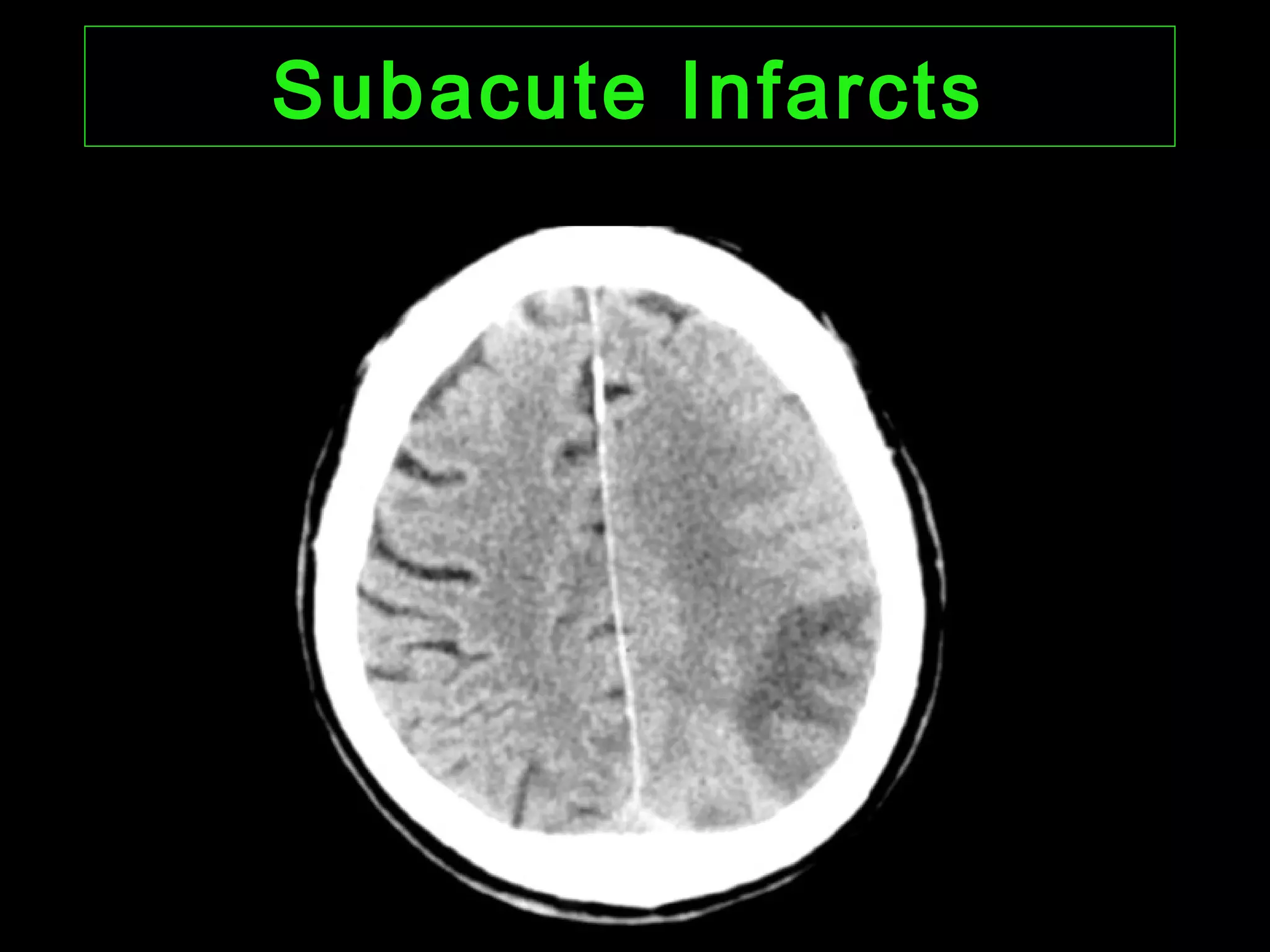 CT Imaging of Cerebral Ischemia and Infarction | PPT