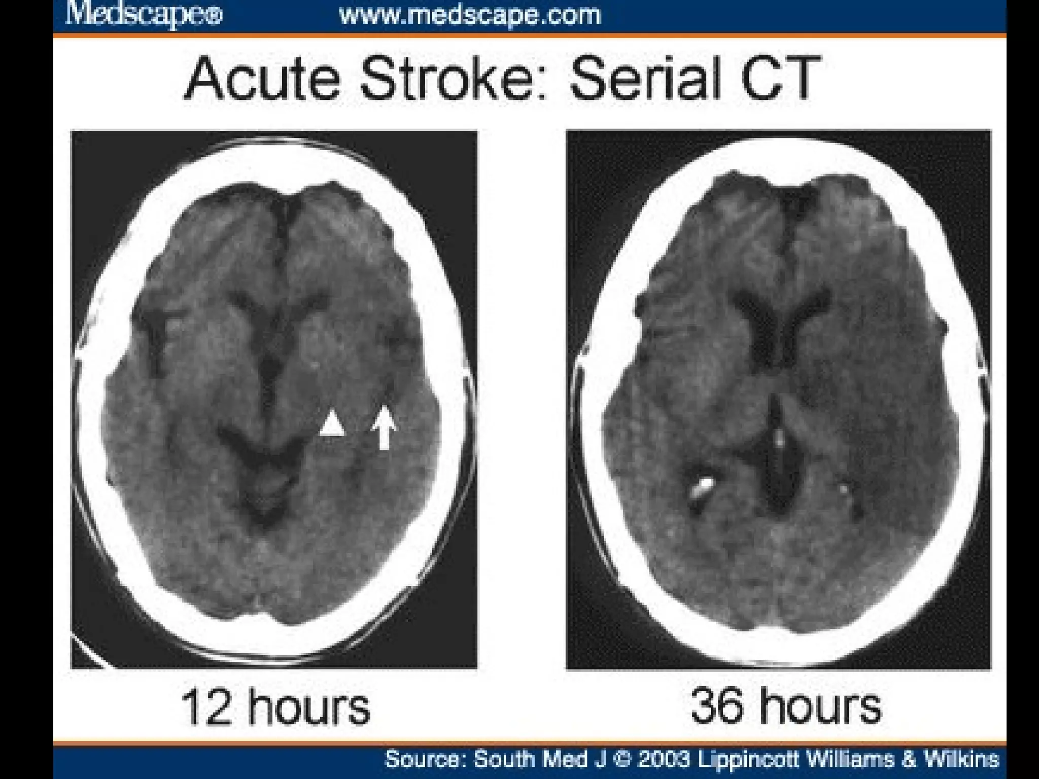 CT Imaging of Cerebral Ischemia and Infarction | PPT