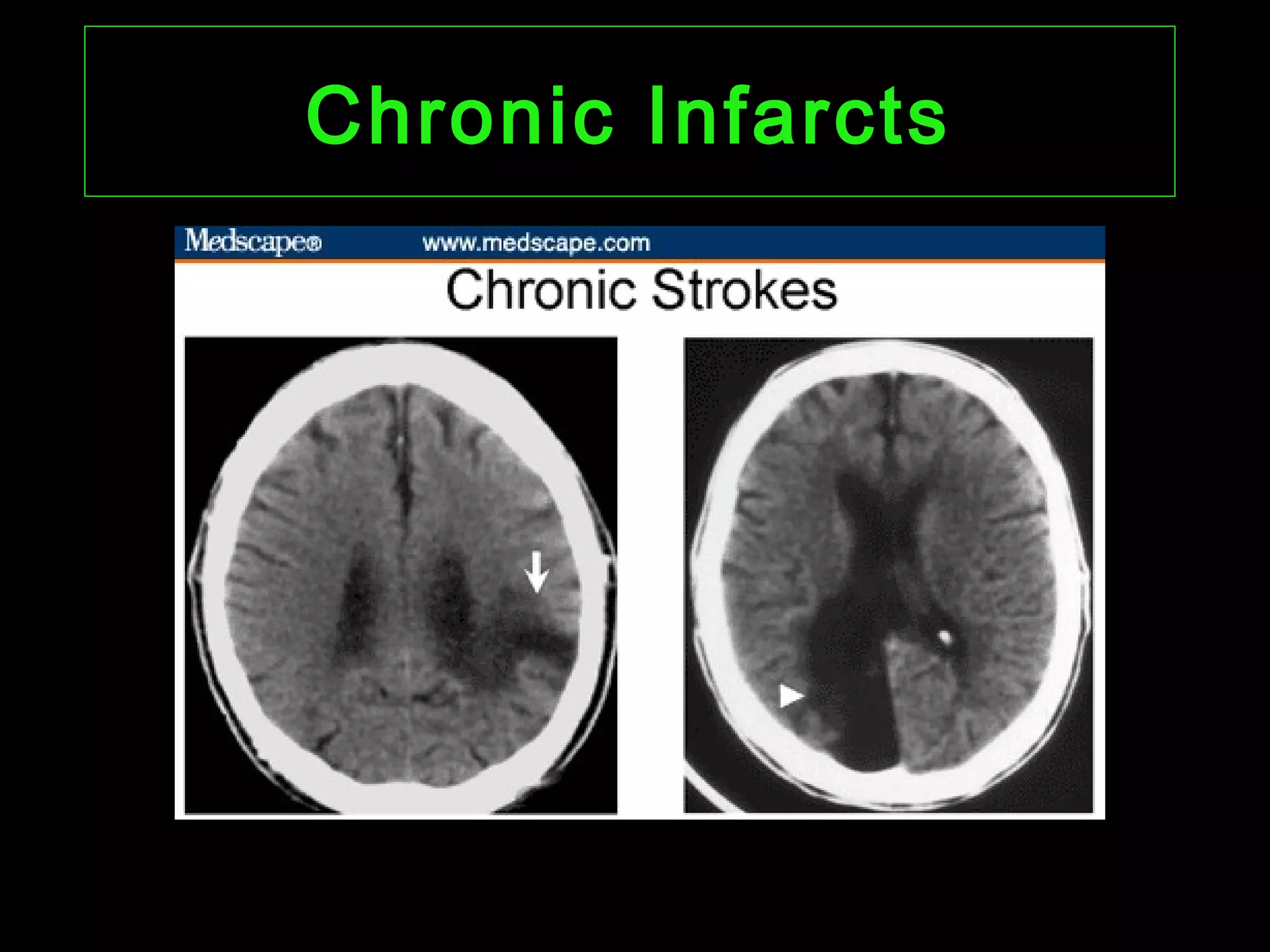 CT Imaging of Cerebral Ischemia and Infarction | PPT