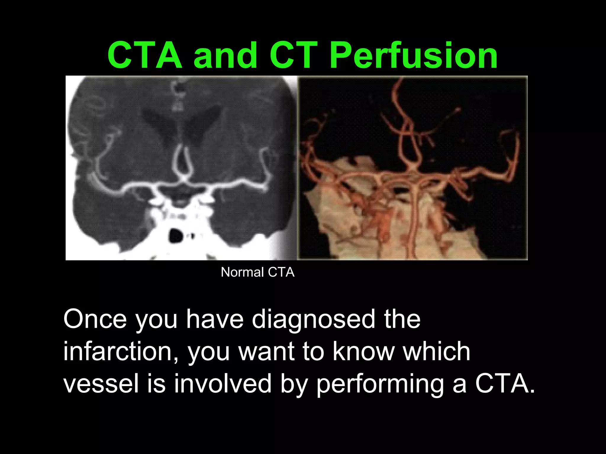 CT Imaging of Cerebral Ischemia and Infarction | PPT