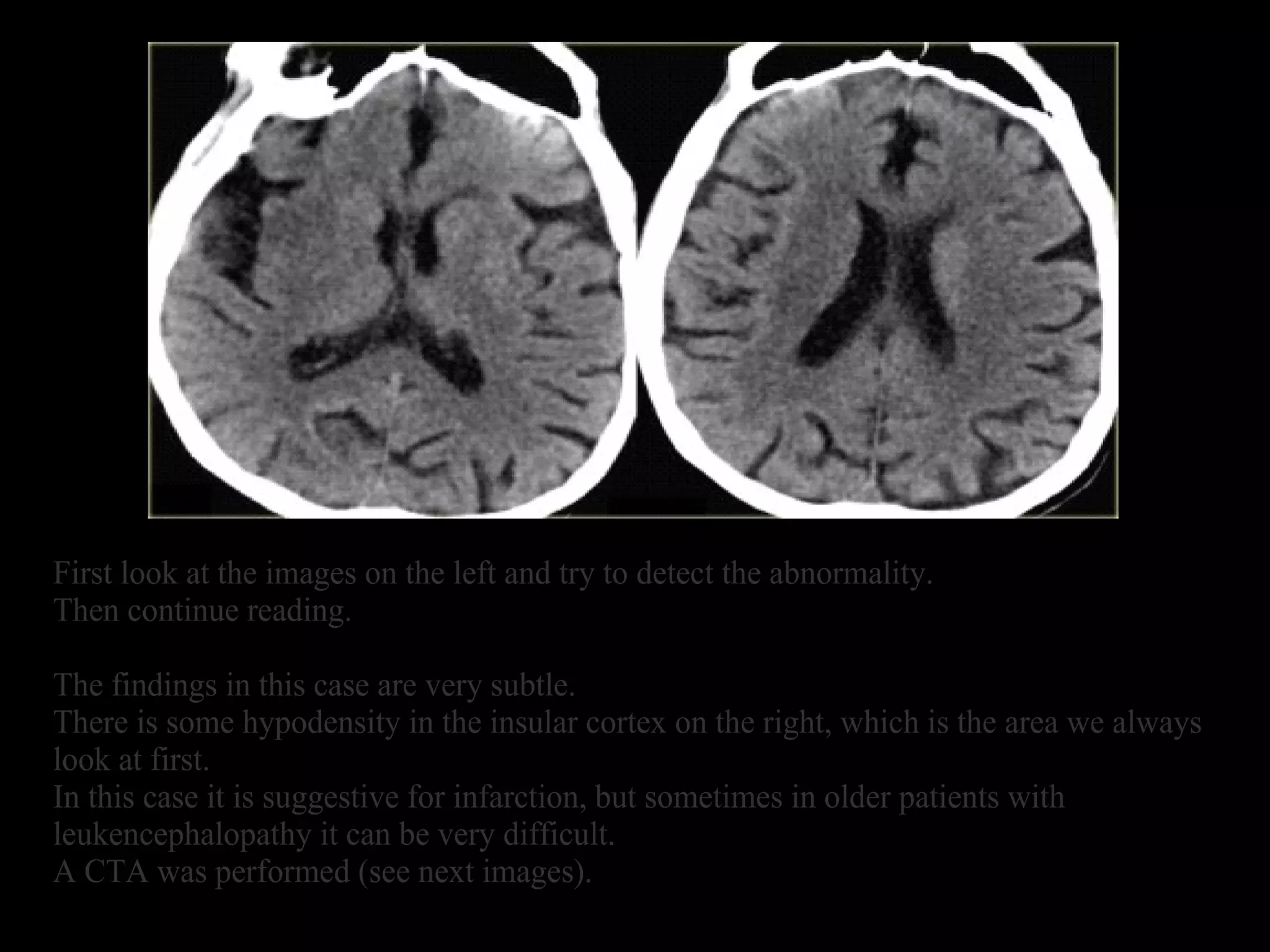CT Imaging of Cerebral Ischemia and Infarction | PPT