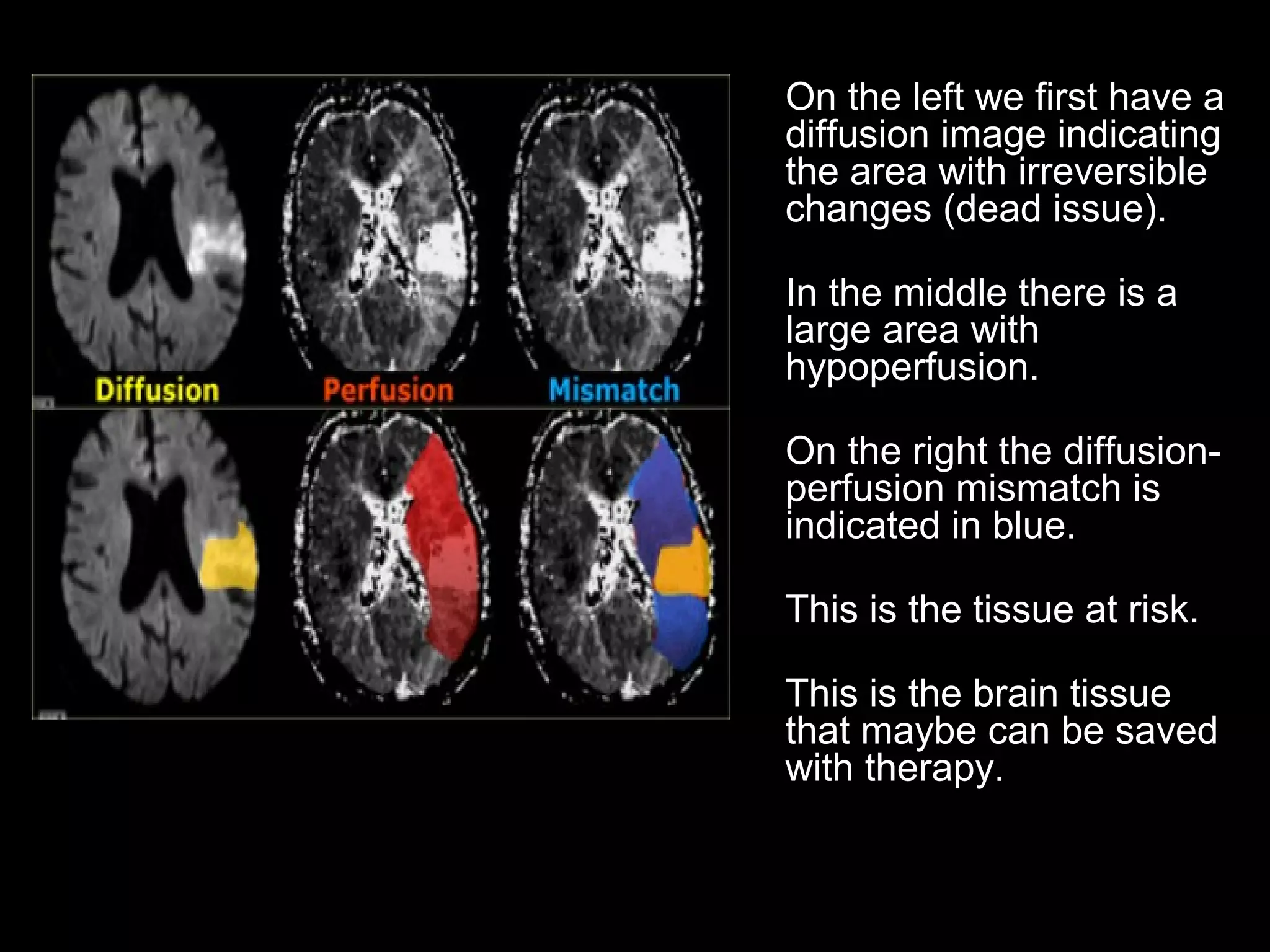 CT Imaging of Cerebral Ischemia and Infarction | PPT