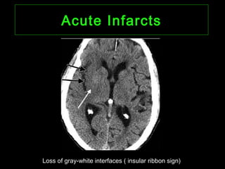 CT Imaging of Cerebral Ischemia and Infarction | PPT