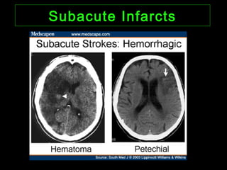 CT Imaging of Cerebral Ischemia and Infarction | PPT