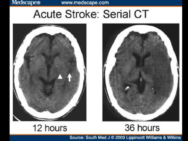 CT Imaging of Cerebral Ischemia and Infarction | PPT