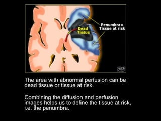 CT Imaging of Cerebral Ischemia and Infarction | PPT