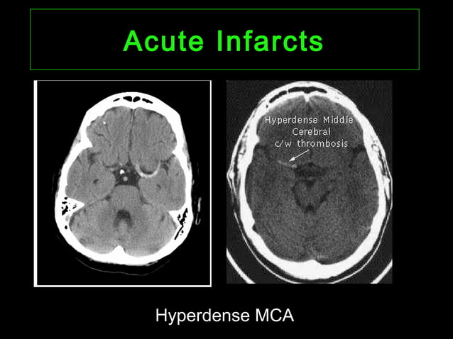 CT Imaging of Cerebral Ischemia and Infarction