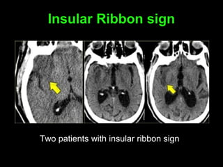 Insular Ribbon Sign