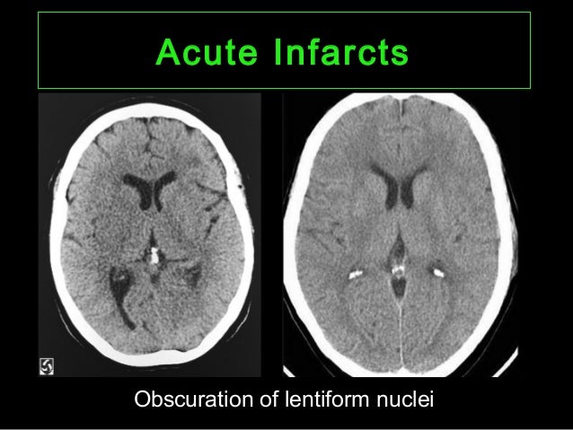 CT Imaging of Cerebral Ischemia and Infarction