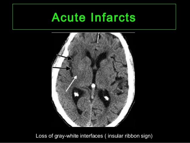 CT Imaging of Cerebral Ischemia and Infarction