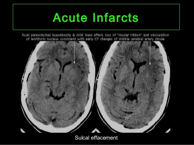 CT Imaging of Cerebral Ischemia and Infarction