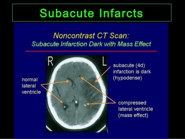 CT Imaging of Cerebral Ischemia and Infarction