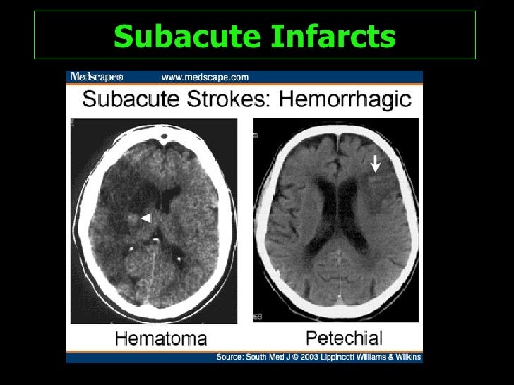 Cerebral Ischemia