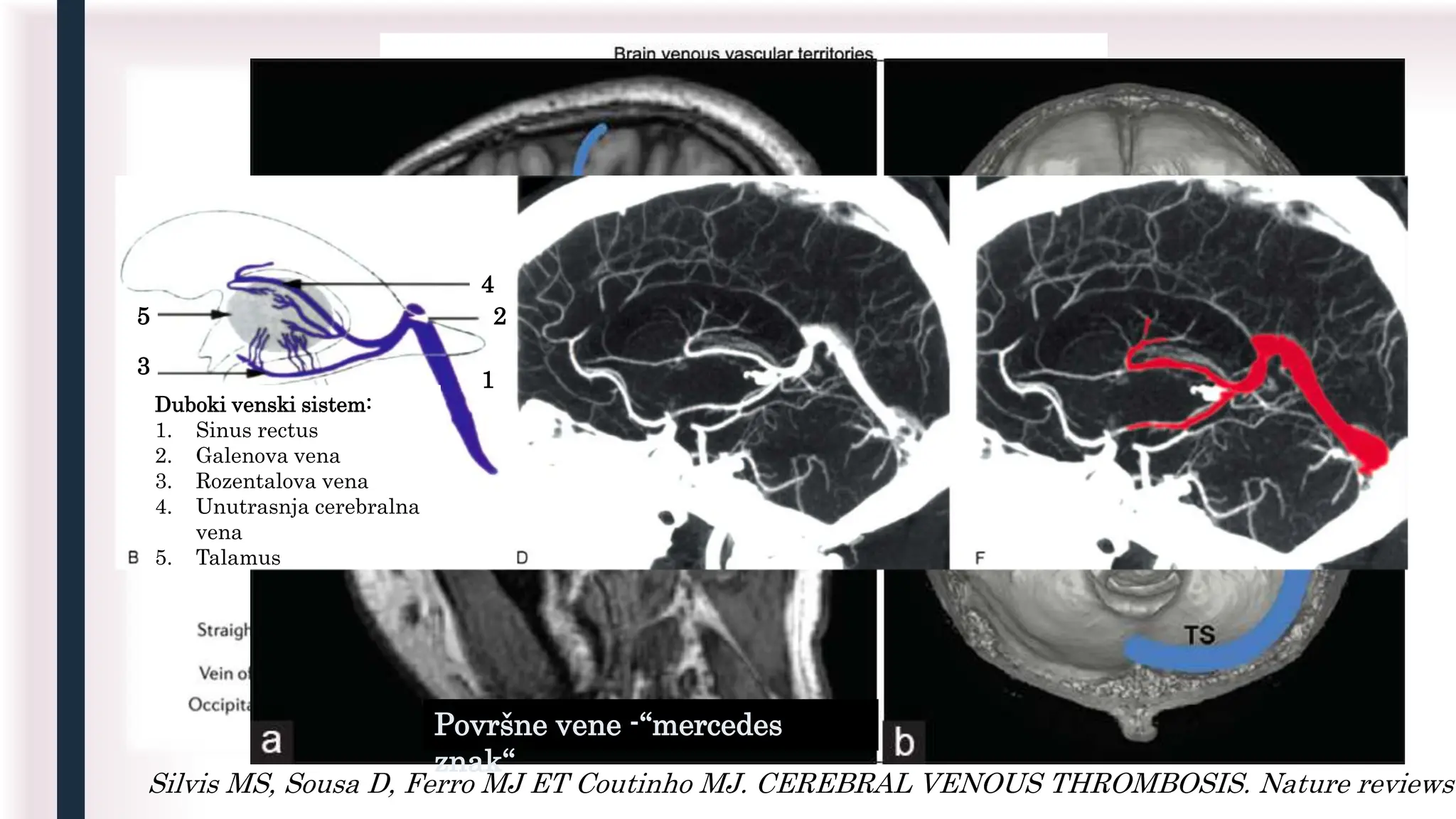 Cerebralne venske tromboze prezentacija venous cerebral thrombosis | PPTX