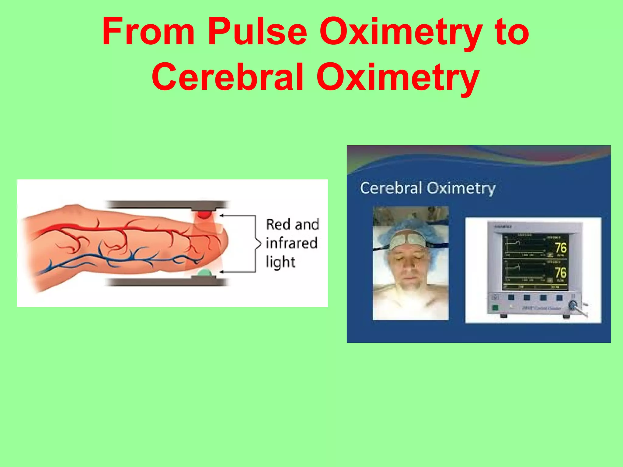 Cerebral oximetry brain protection in cardiac surgery | PPT