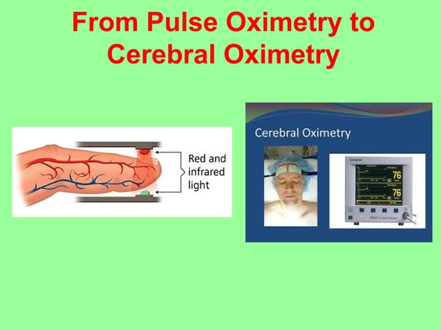 Cerebral oximetry brain protection in cardiac surgery | PPT | Brain and ...