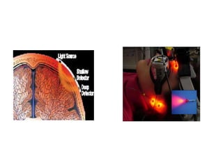 Cerebral oximetry in cerebral resuscitation | PPTX