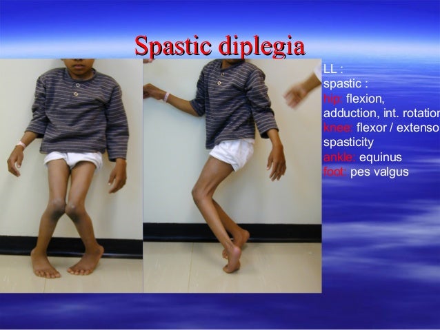 Cerebral palsy الشلل الدماغي