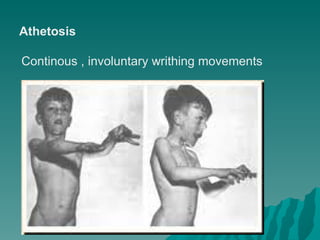 orthopedics.Cerebral palsy.(dr.baxtyar rasul) | PPT