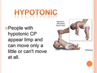 Cerebral palsy | PPTX