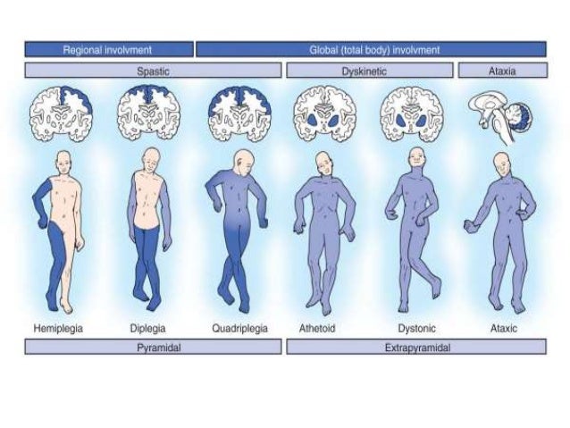 Cerebral palsy BY SHARADA PRASAD SINGH