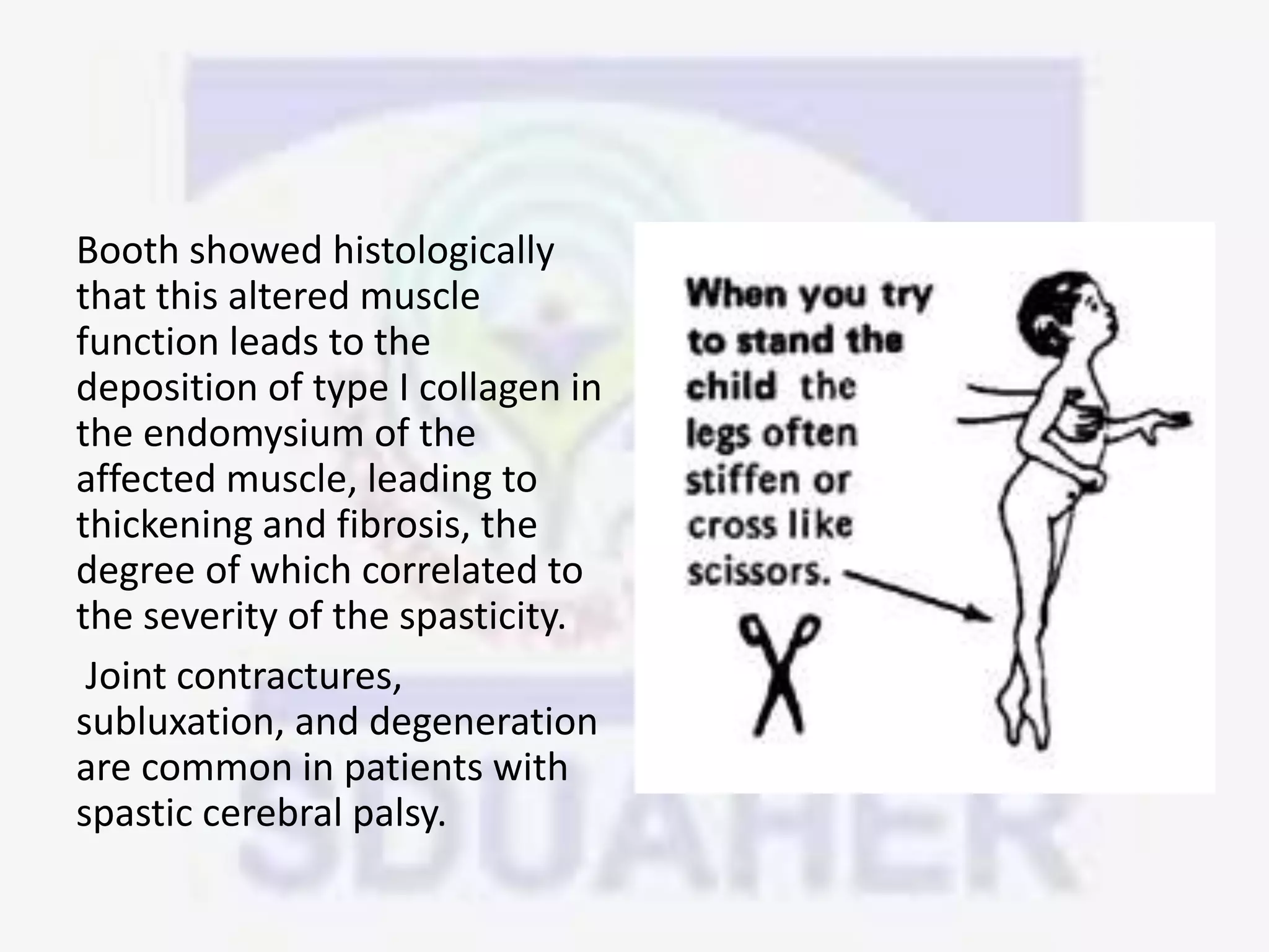 Cerebral palsy classification | PPTX